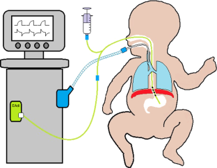 Modes and strategies for providing conventional mechanical ventilation ...