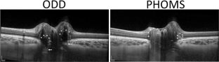 Optic disc drusen in children: morphologic features using EDI-OCT | Eye