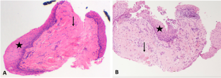 The clinical and histopathological characteristics of Kelly punch ...