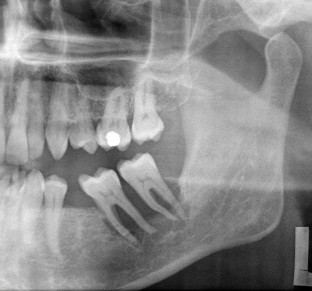 Imaging patients with cancer of the oral cavity | British Dental Journal