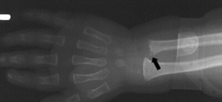 Scheurbuik bij eenzijdige voeding | SpringerLink