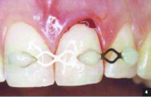 Titanium Trauma Splint (TTS) bij tandletsel | SpringerLink