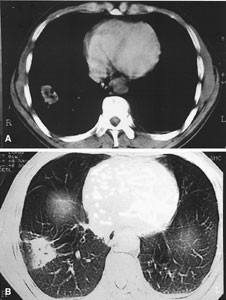 Modified PAIR Technique for Percutaneous Treatment of High-Risk Hydatid ...