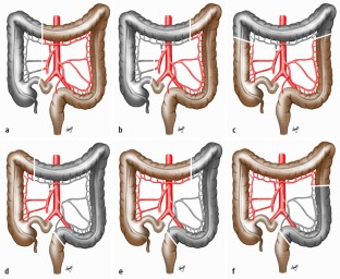 Leitliniengerechte Therapie des Kolonkarzinoms | SpringerLink