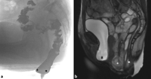 Externer Rektumprolaps | SpringerLink
