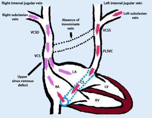 Persistent left superior vena cava, absence of the innominate vein, and ...