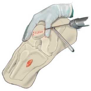 Anatomische Rekonstruktion des medialen patellofemoralen Bands mit ...