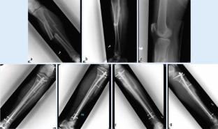 Intramedulläre Nagelung von proximalen Tibiafrakturen | SpringerLink