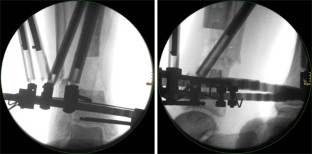 Die Masquelet-Technik zur Behandlung großer dia- und metaphysärer ...