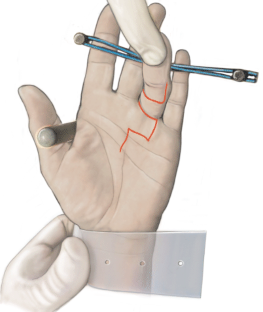 Lappenplastiken bei fortgeschrittenem Morbus Dupuytren | SpringerLink