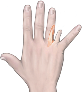 Lappenplastiken bei fortgeschrittenem Morbus Dupuytren | SpringerLink