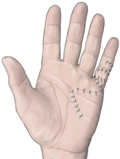 Lappenplastiken bei fortgeschrittenem Morbus Dupuytren | SpringerLink