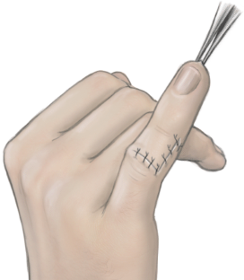 Lappenplastiken bei fortgeschrittenem Morbus Dupuytren | SpringerLink