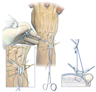 Die arthroskopisch unterstützte transkapsuläre Refixation des Discus ...