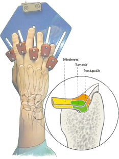 Die arthroskopisch unterstützte transkapsuläre Refixation des Discus ...