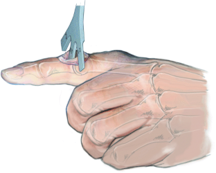 Oberflächenersatz am Fingermittelgelenk mittels CapFlex-PIP | SpringerLink