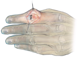 Oberflächenersatz am Fingermittelgelenk mittels CapFlex-PIP | SpringerLink