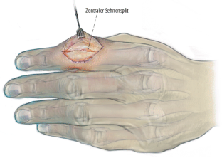 Oberflächenersatz am Fingermittelgelenk mittels CapFlex-PIP | SpringerLink
