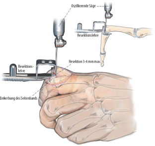 Oberflächenersatz am Fingermittelgelenk mittels CapFlex-PIP | SpringerLink