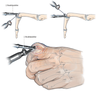Oberflächenersatz am Fingermittelgelenk mittels CapFlex-PIP | SpringerLink