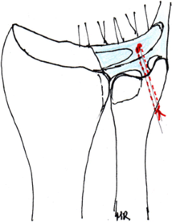 Arthroscopic treatment for ulnar-sided TFCC-tears | SpringerLink