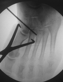 Lisfranc fleck sign: characteristics and clinical outcomes following ...