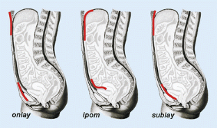 Narbenhernien | SpringerLink