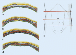 Zugangswege zur Bauchhöhle und Möglichkeiten der Drainage | SpringerLink