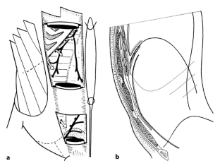 Funktionelle Anatomie der Bauchwand | SpringerLink