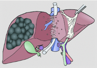 Technik der Leberresektion | SpringerLink