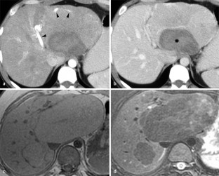 Diagnose und Differenzialdiagnose benigner Lebertumoren und ...