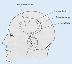 diagnostik-und-therapie-von-sch-del-hirn-traumen-springerlink