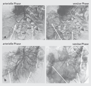 Akute intestinale Ischämie | SpringerLink