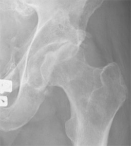 Aktuelle Therapieoptionen bei Hüftkopfluxationsfrakturen | SpringerLink