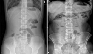 Konservative und operative Therapie des Ileus | SpringerLink