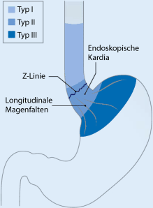 Differenziertes chirurgisches Vorgehen bei Adenokarzinomen des ...