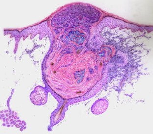 Pathophysiologie der Akne | SpringerLink