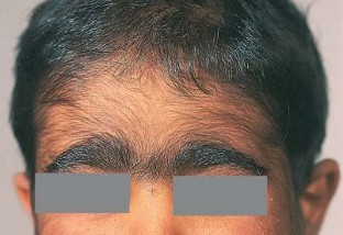 Hypertrichose | SpringerLink