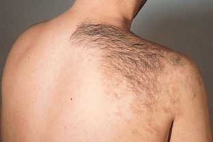 Hypertrichose | SpringerLink