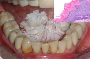 Plattenepithelkarzinom und potenziell maligne Veränderungen der ...