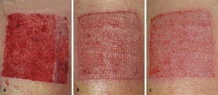 Wundheilung | SpringerLink