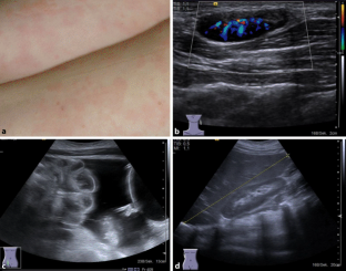 Morbus Still im Kindes- und Erwachsenenalter | SpringerLink
