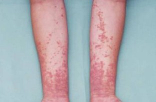 Lichen ruber planus | SpringerLink