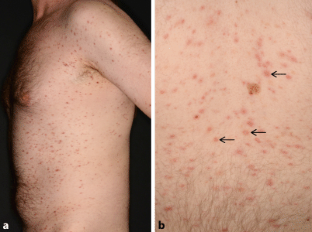 Varizellen unter dem klinischen Bild einer Pityriasis lichenoides et ...