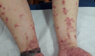 Atypische Hand-Fuß-Mund-Krankheit | SpringerLink