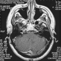 Ocular Tilt Reaction | SpringerLink