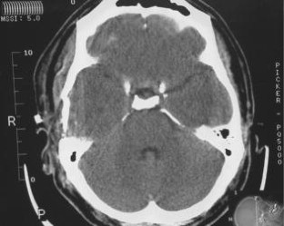Ocular Tilt Reaction | SpringerLink