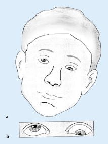 Ocular Tilt Reaction | SpringerLink