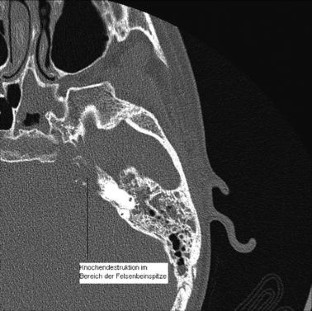 Isolierte apikale Petrositis | SpringerLink