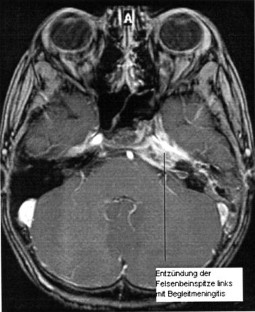 Isolierte apikale Petrositis | SpringerLink